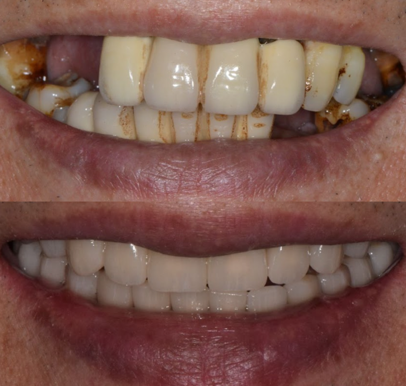 Nowe zęby w jeden dzień – czy to możliwe? - Klinika Wiktorska